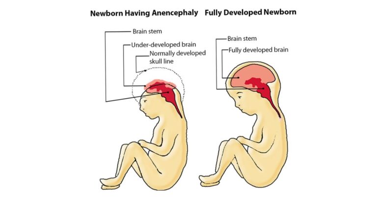 Difference Between Acrania And Anencephaly: Protect Your Babies Before ...