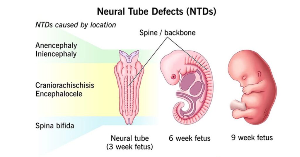 Difference Between Acrania And Anencephaly: Protect Your Babies Before ...
